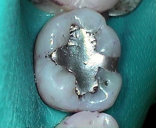 Safe Amalgam Removal in Centennial, CO | Colorado Wellness Dentistry